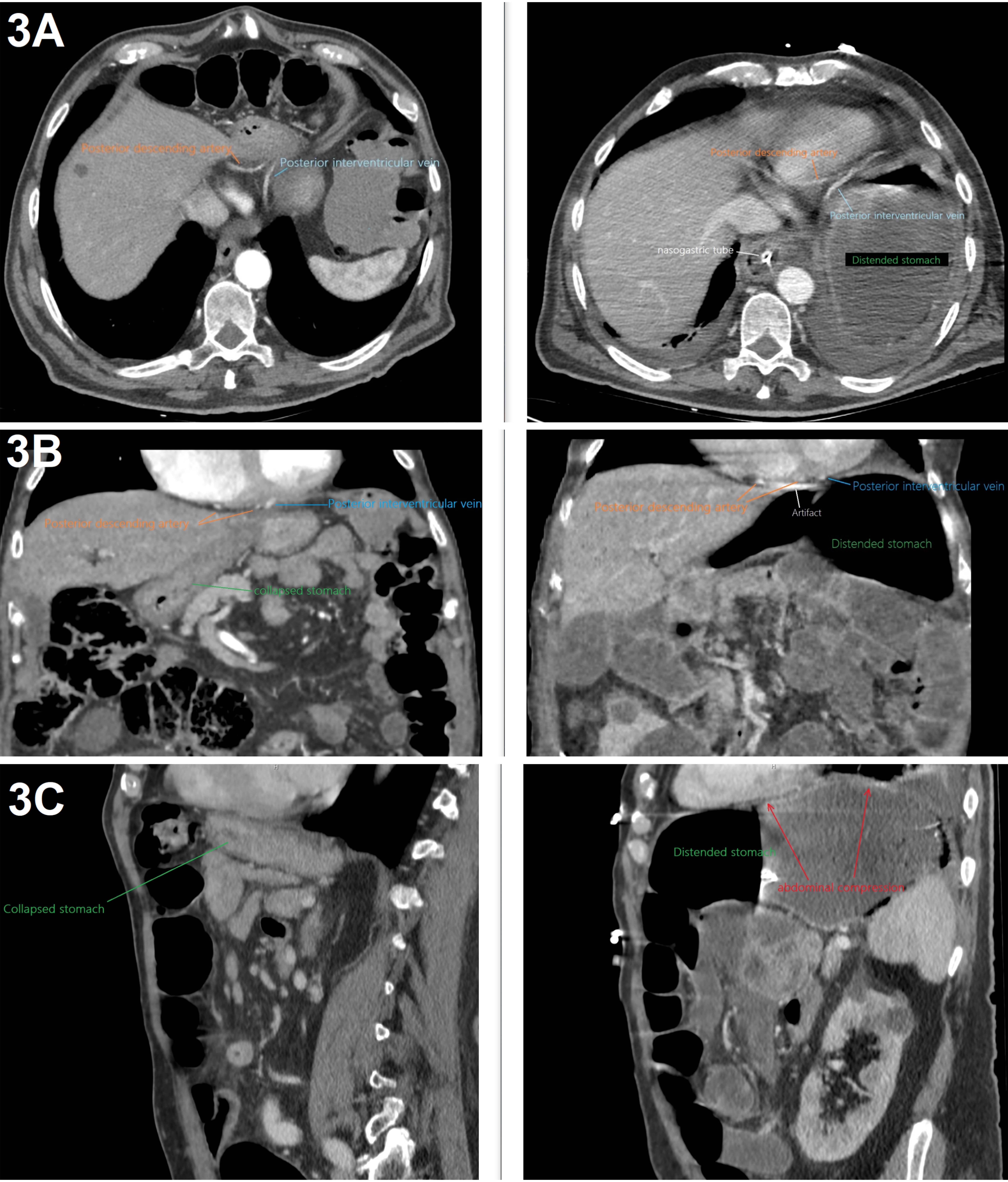 Cardiac extrinsic compression due to abdominal distension as a cause of ...